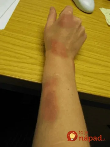 Rada pre každého, kto sa potrebuje rýchlo zbaviť modriny: Finta našich ...