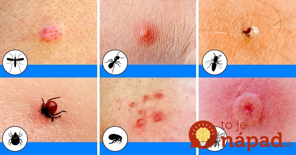 9 druhov štípancov, ktoré by mal rozpoznať každý: Podľa tohoto jasne ...