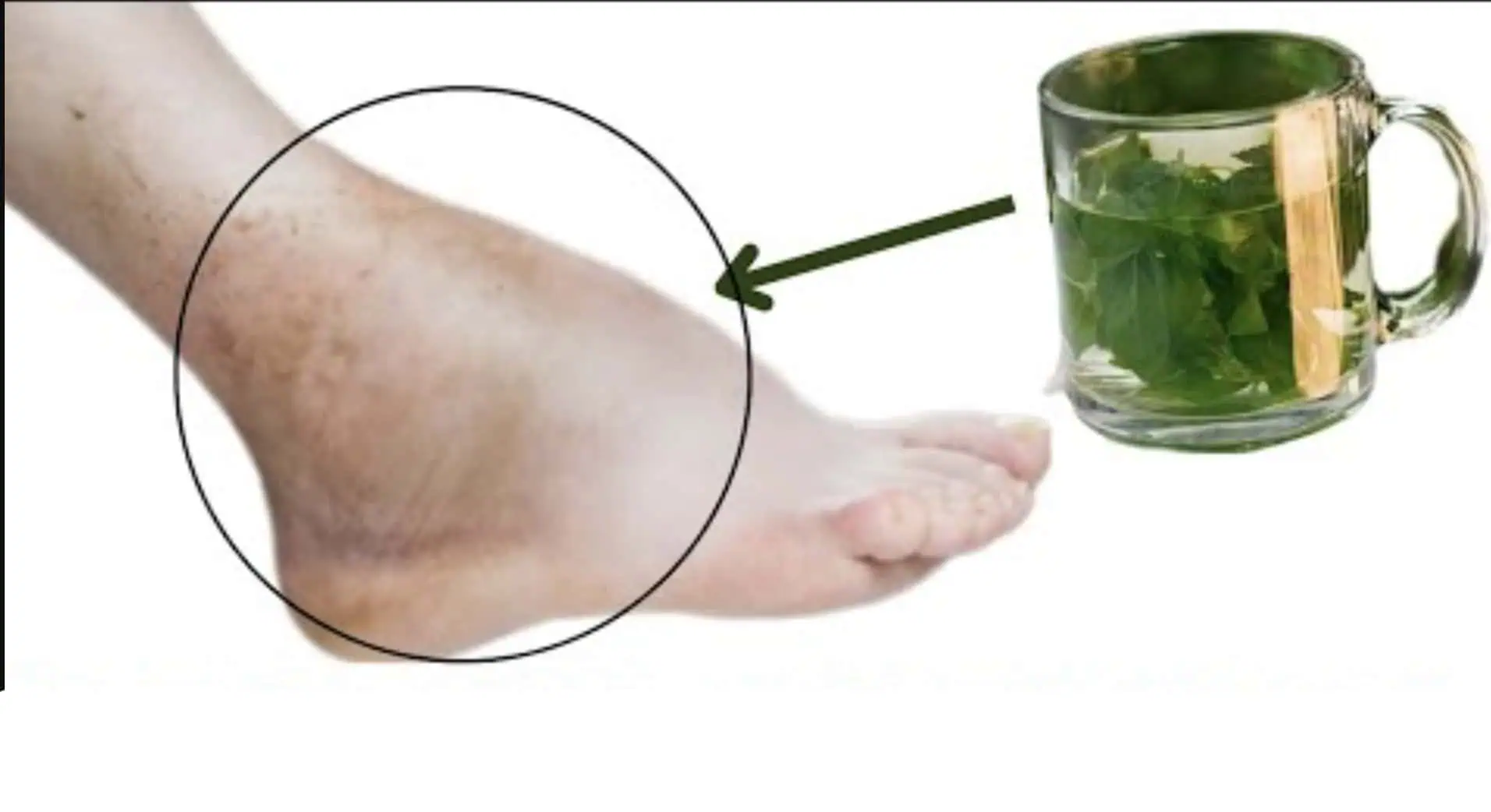 Pite tento čaj a zabudnite na opuchy členkov, nôh, aj chodidiel!